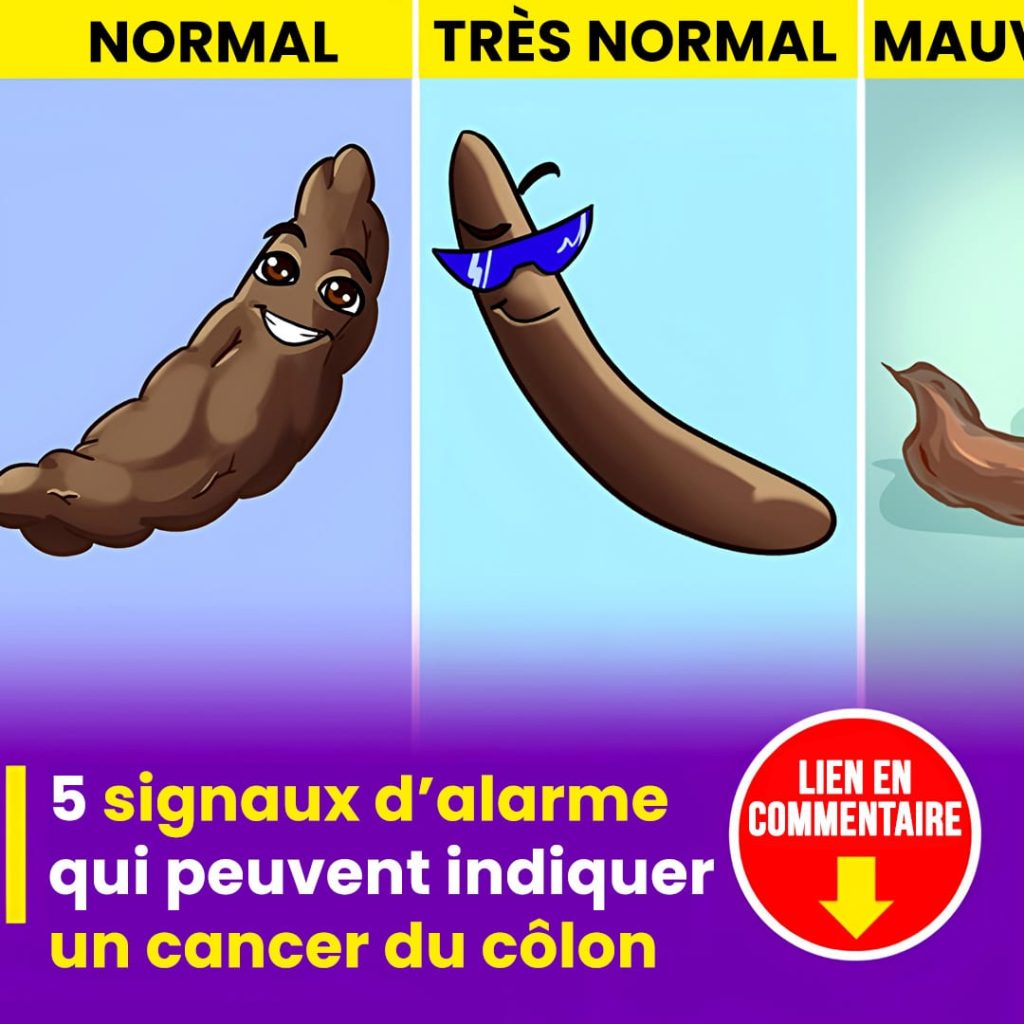 Les indices subtils d'un éventuel cancer du côlon - Infos Astuces