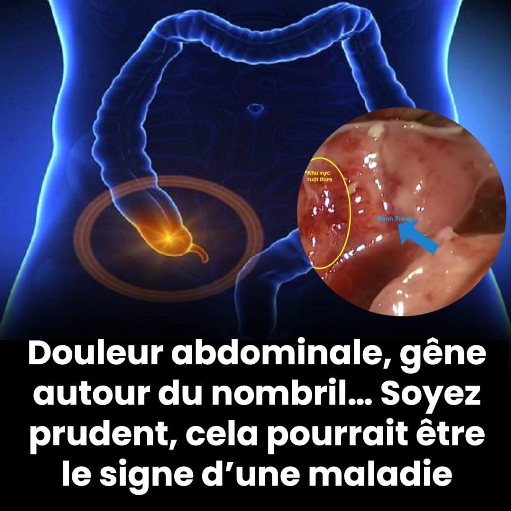 Comprendre les maux de ventre autour du nombril : Ce qu'il faut savoir ...